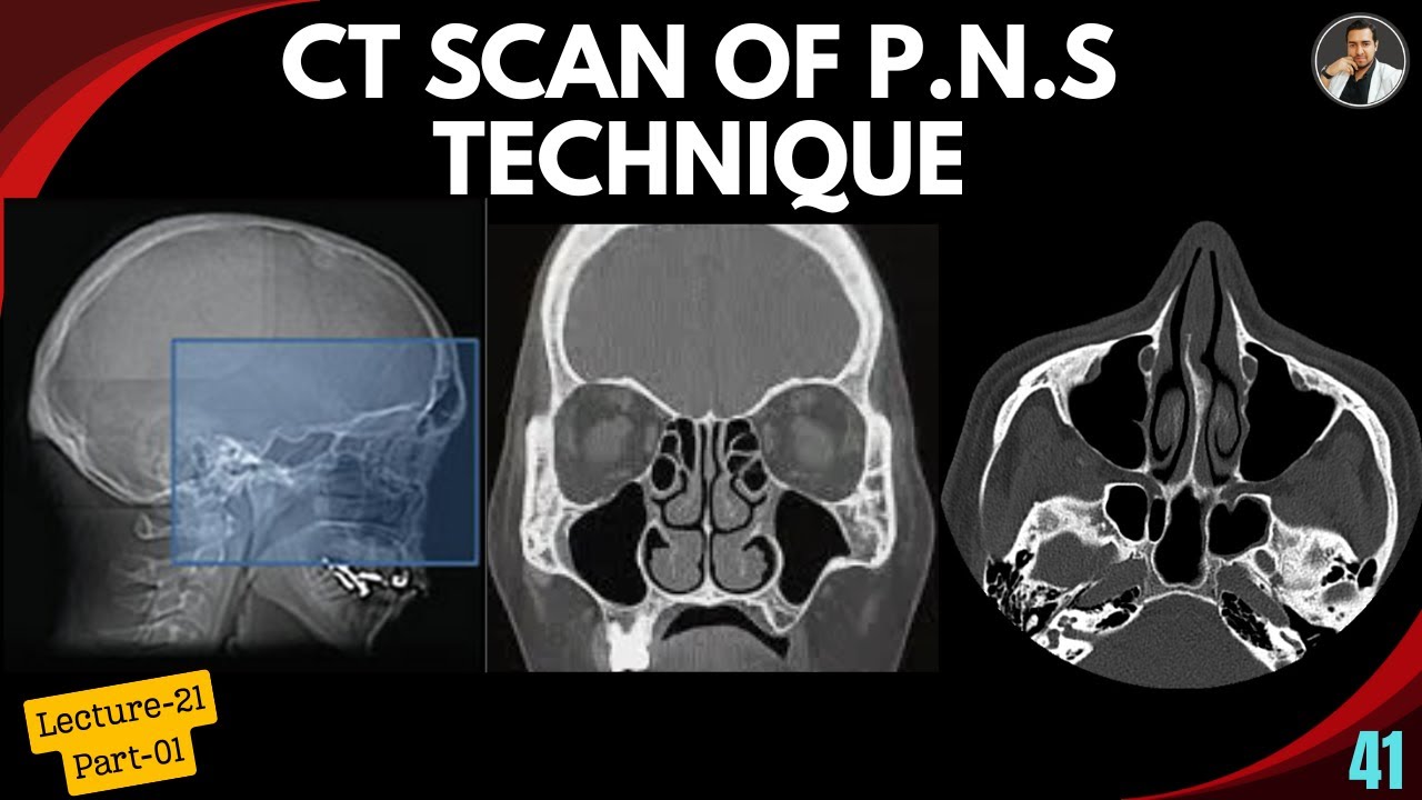 Ct Pns Anatomy Computed Tomography Of The Face And Paranasal Sinuses: