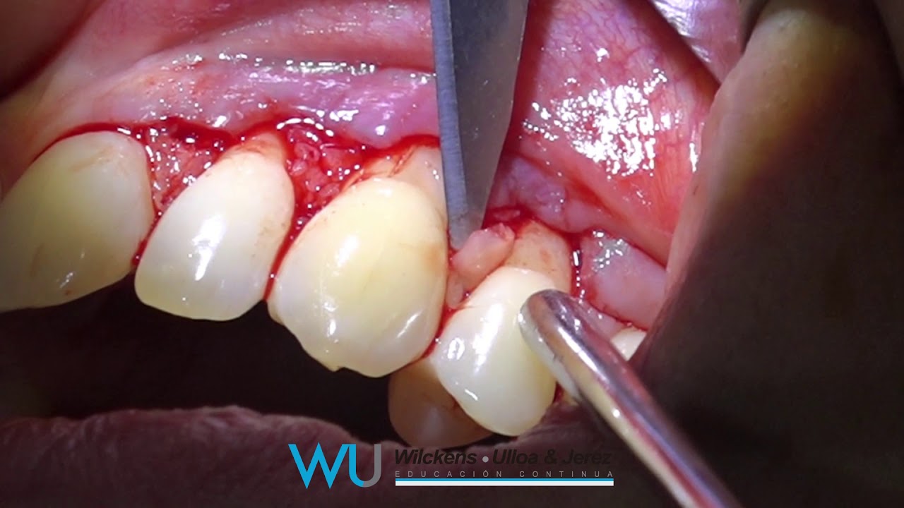 Técnica de Zucchelli - YouTube