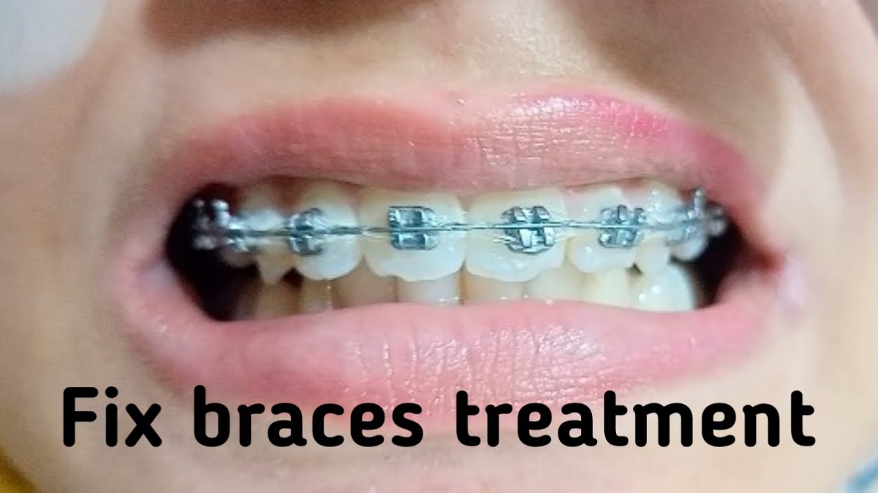 Fix braces |fix braces treatment - YouTube