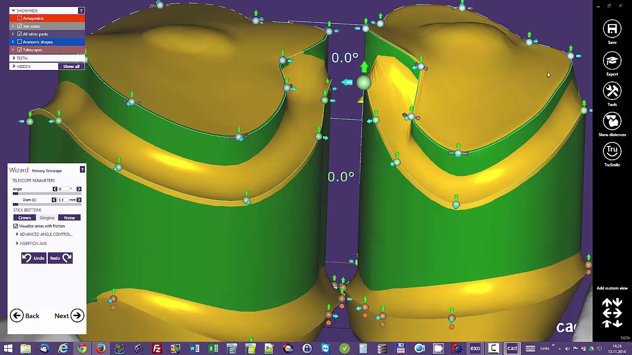 Exocad attachment design demo video-Shining 3D - YouTube