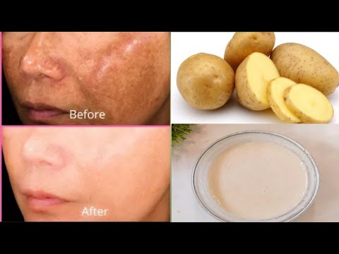 This Potato Face Pack removes Dark Spots, Suntan, Acne Scars ...