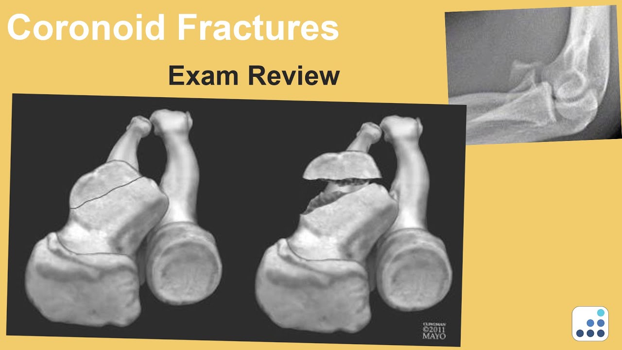 Coronoid Fractures Exam Review - Mark S. Cohen, MD - YouTube