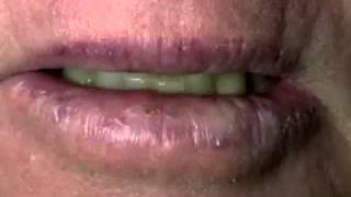 Actinic Cheilitis