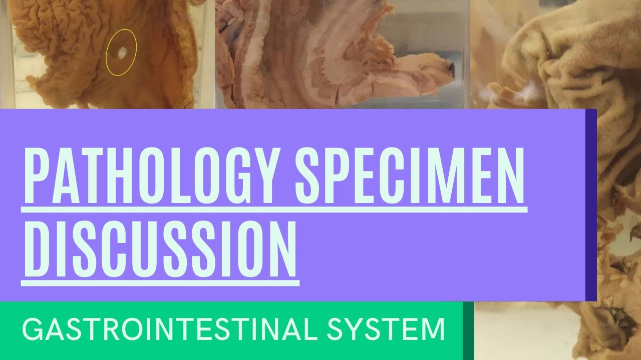Pathology Specimen Discussion | Gastrointestinal System - YouTube