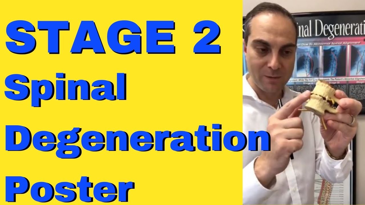 Part 3 of 5 - Stage 2 - Stages of Spinal Degeneration Poster - by ...