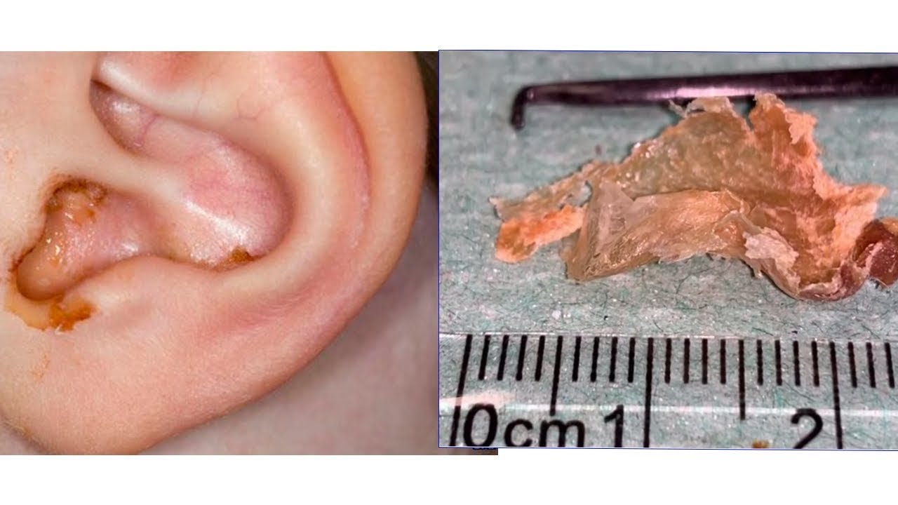 Blocked Earwax removal by Doctor Ear cleaning Ep 7 - YouTube