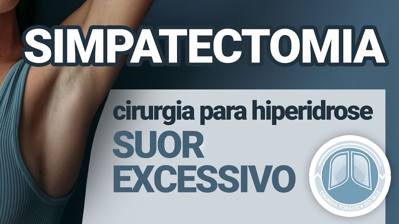 Simpatectomia - (Procedimento com explicação) - Hiperidrose, Suor ...