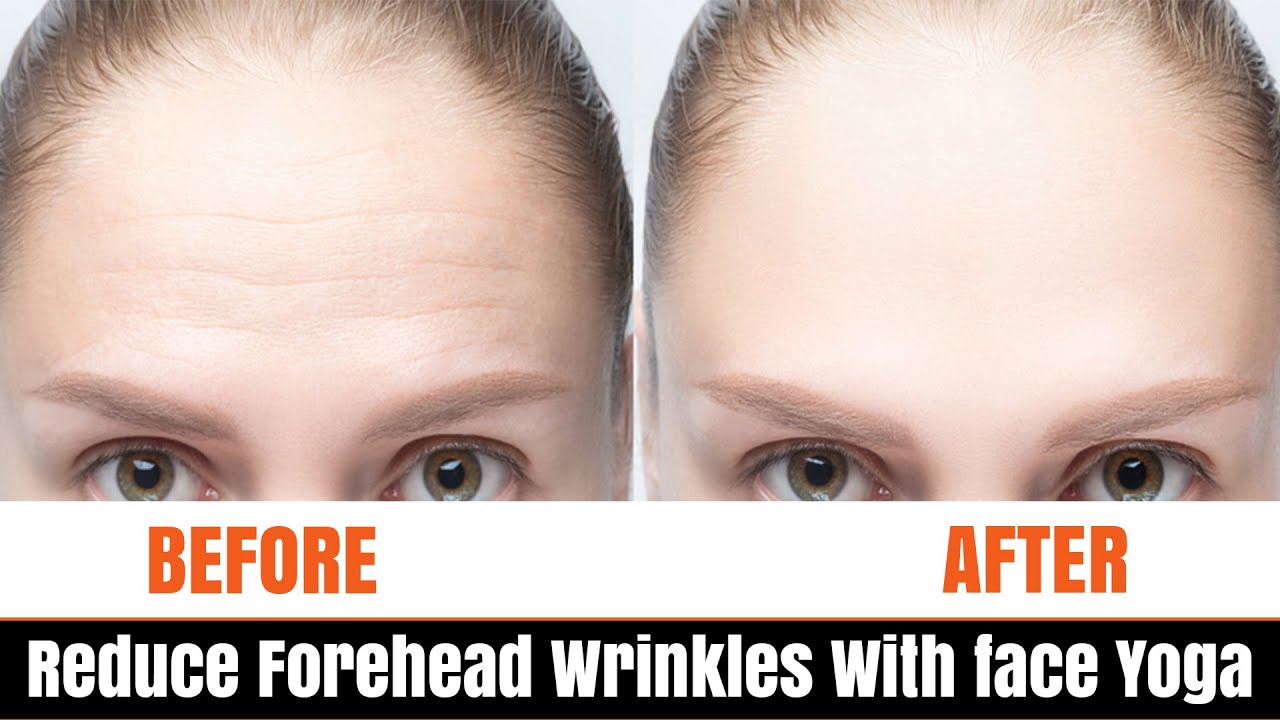 Remove Lines on Forehead| No More Angry Lines| Forehead Wrinkles ...