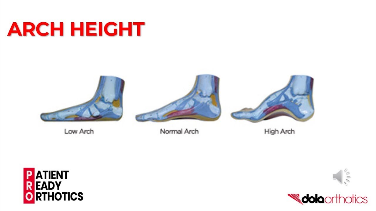 Orthotic selector Arch height classification - YouTube