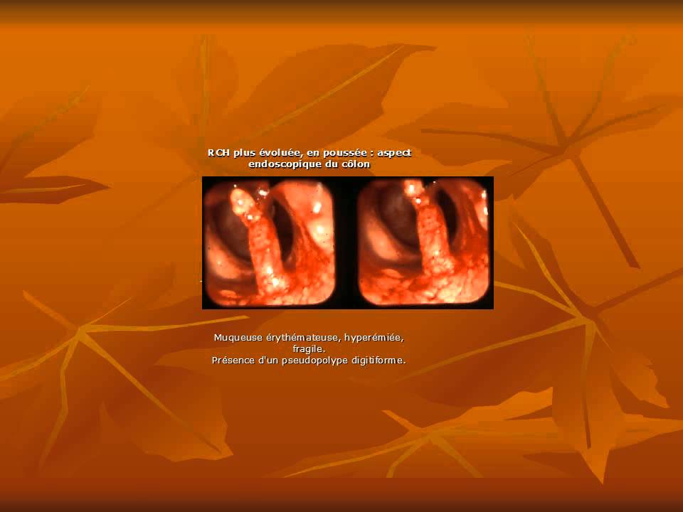 GASTRO-ENTEROLOGIE les maladies inflammatoires chroniques de l'intestin ...