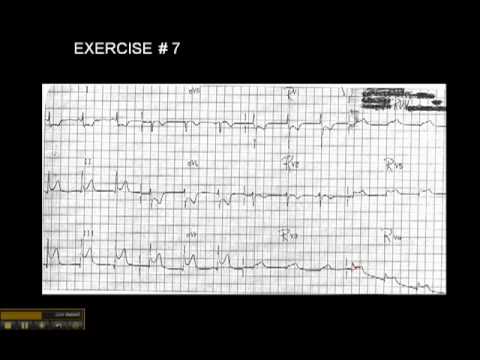 12-15 Lead ECG: Exercise # 7 - YouTube
