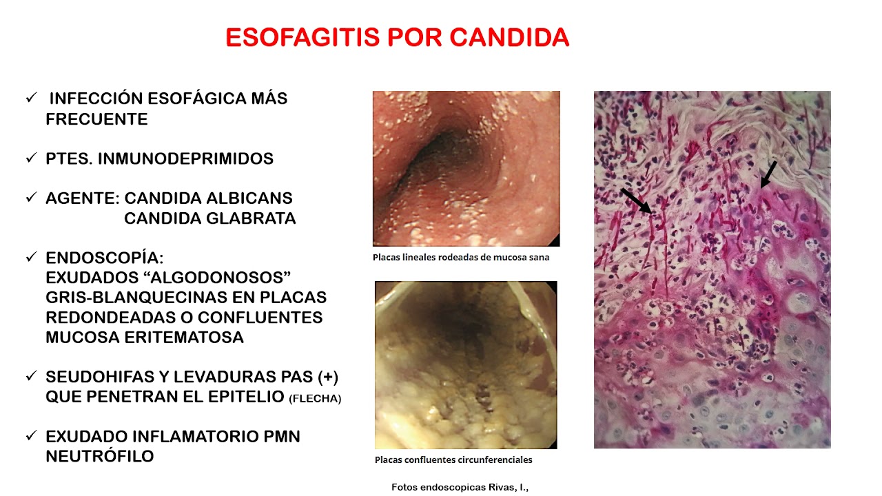 CCGI 1 AP ESOFAGITIS ESOFAGO DE BARRETT - YouTube