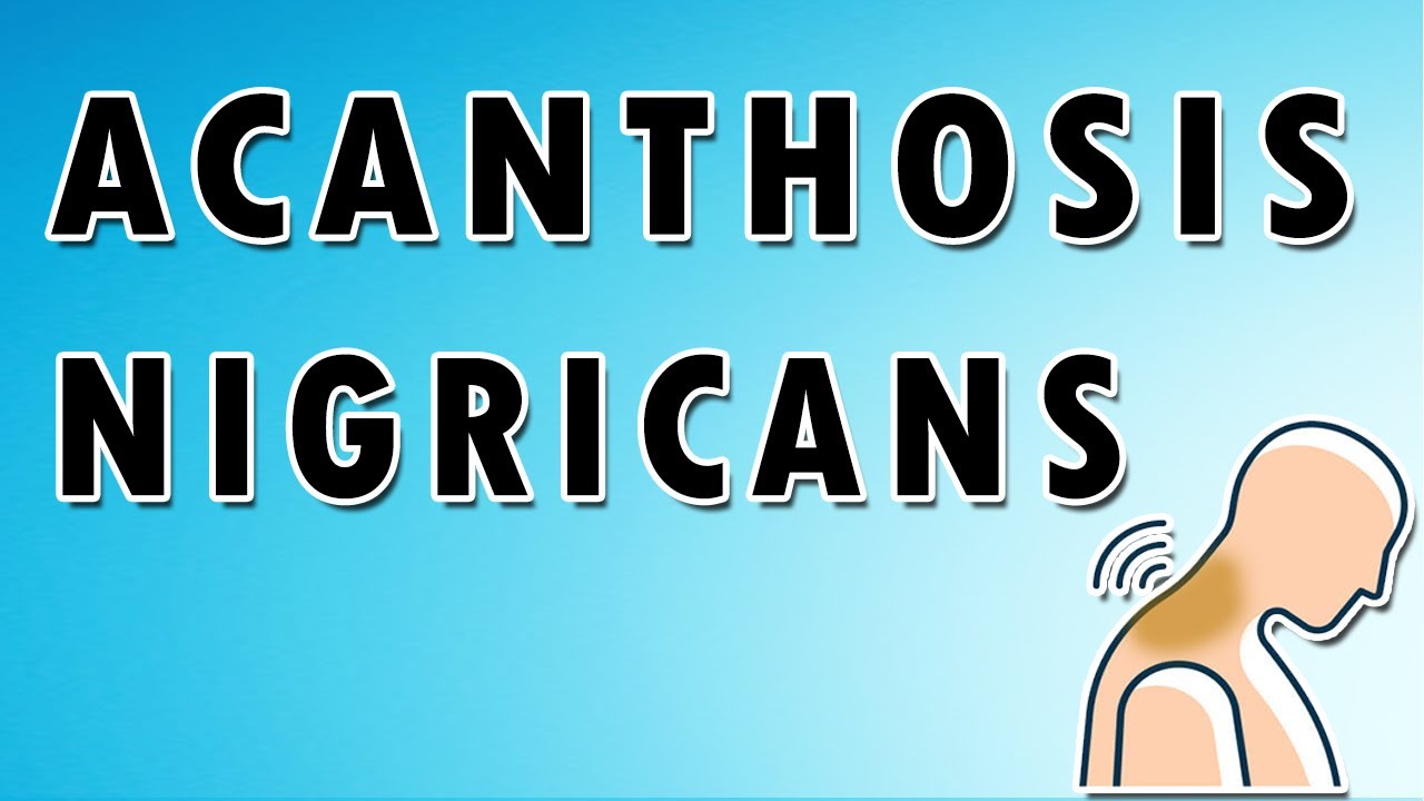 Acanthosis Nigricans Treatment, Causes, and Location (Armpit, Face ...
