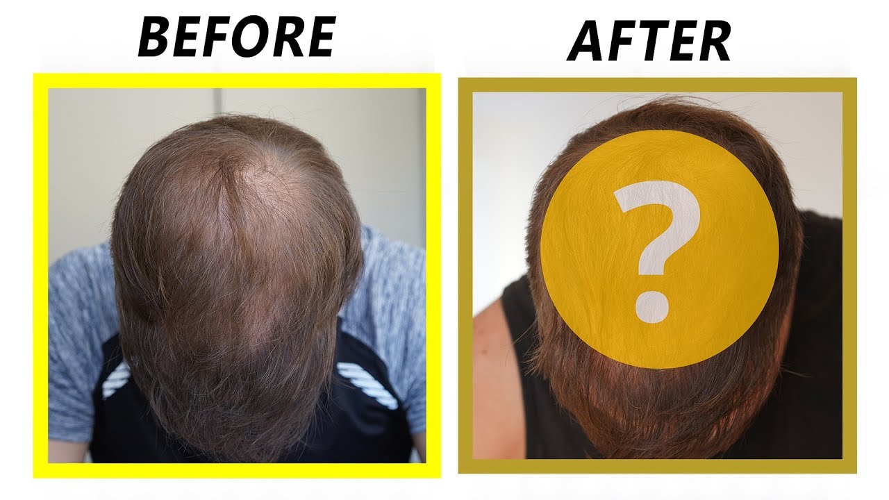 5 months after my 3 PRP Sessions! - YouTube