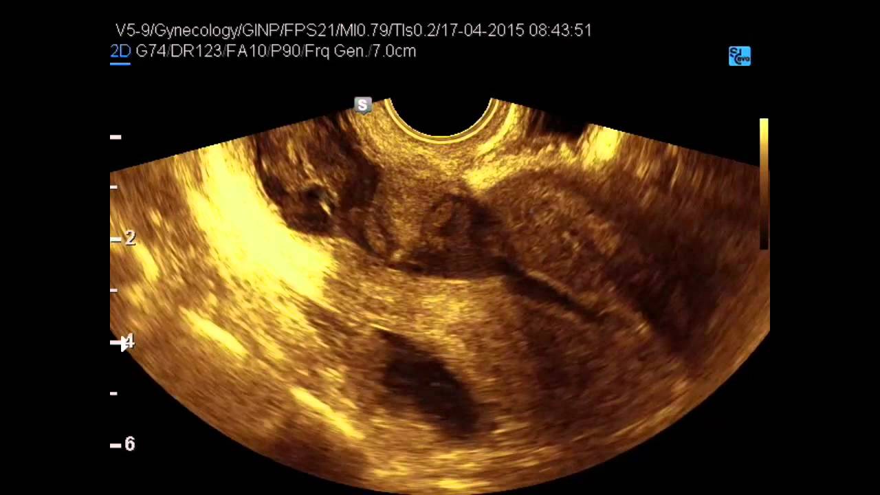 MED2000ECO Istmocele - YouTube