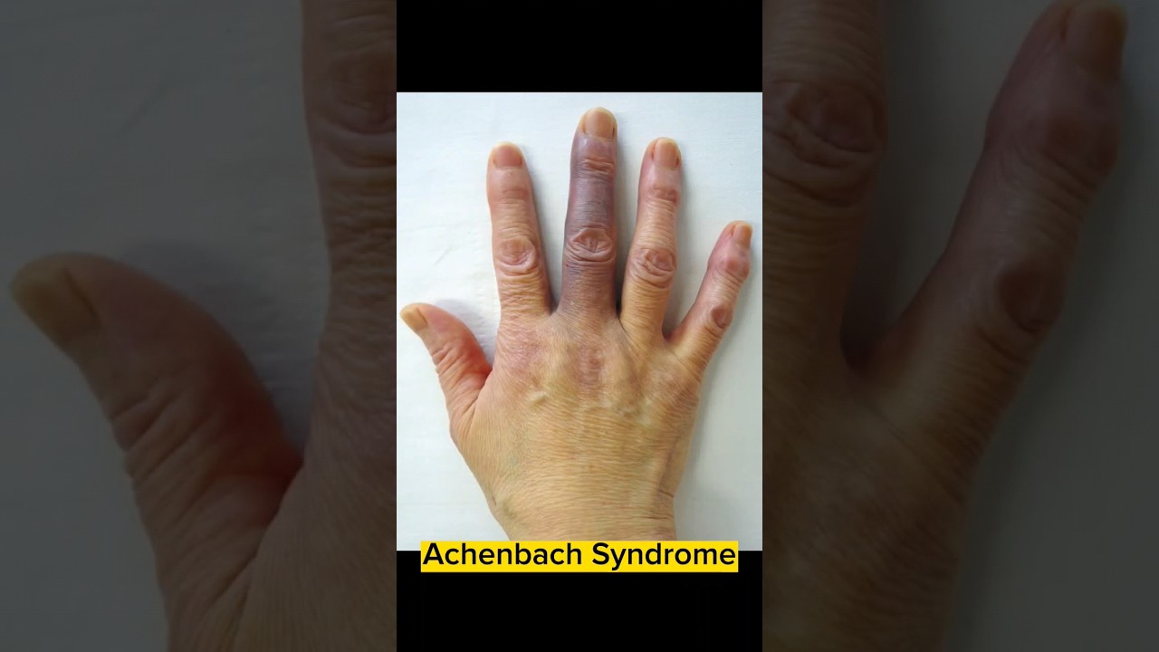 Achenbach Syndrome || Proxysmal Finger Haematoma #doctor #dermatology # ...