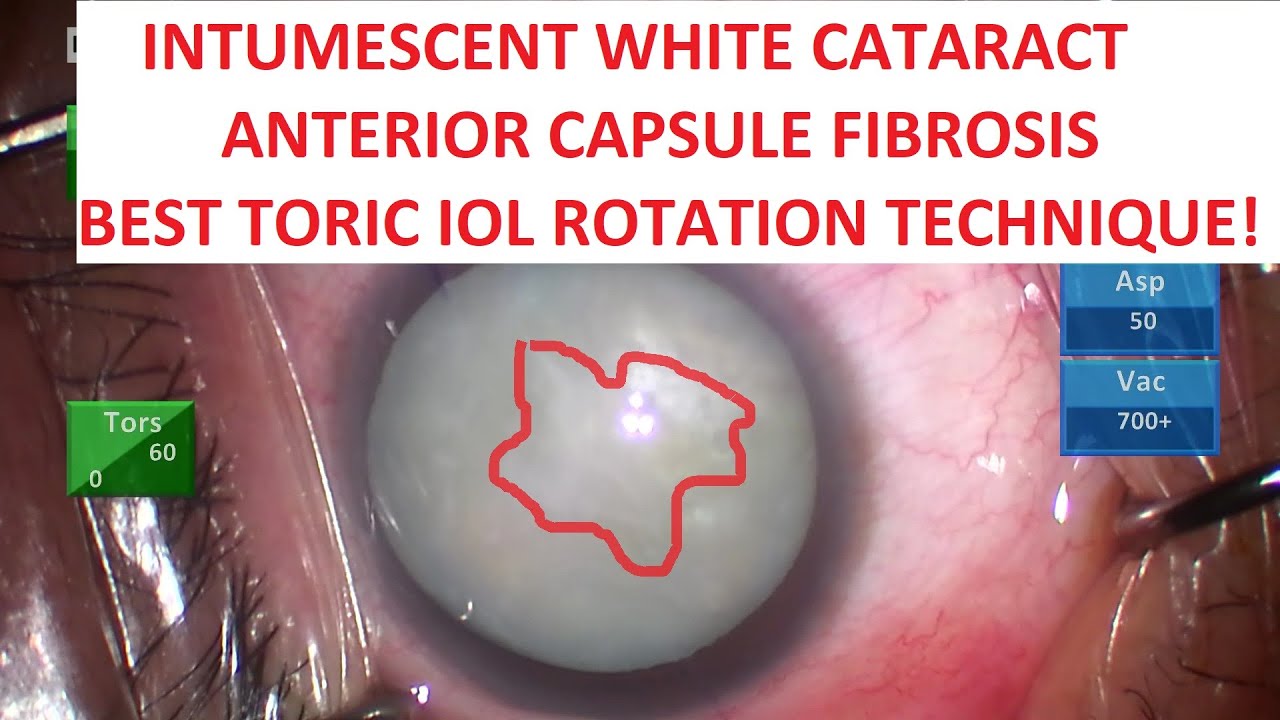 White Intumescent Cataract. Anterior Capsule Fibrosis. Trypan. My Toric ...