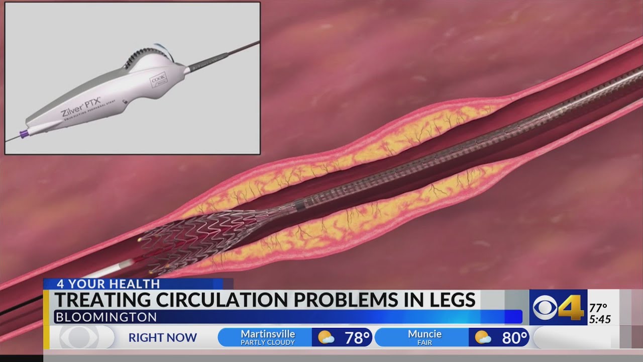 Cook Medical device provides relief from severe peripheral artery ...