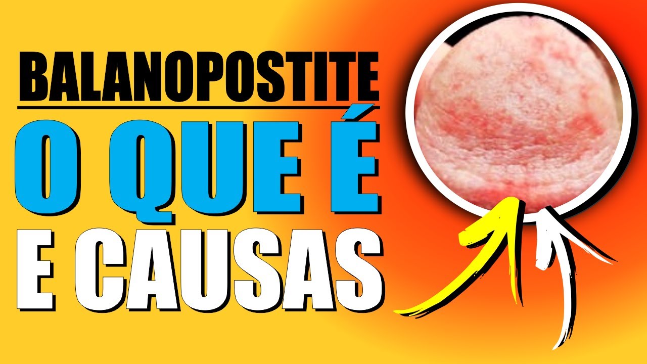 Descubra O QUE É BALANOPOSTITE E Quais São As Principais (CAUSAS DA ...