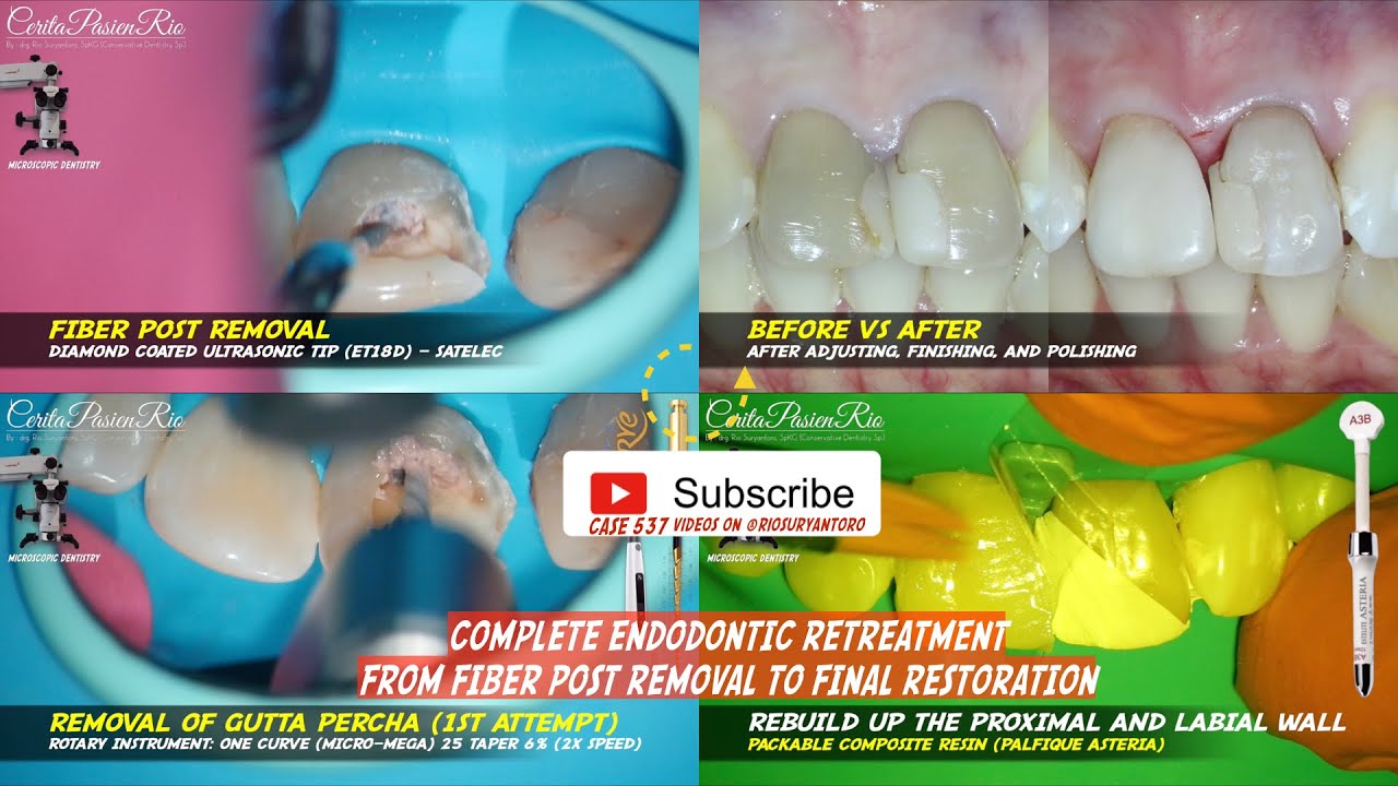 ENDODONTIC RETREATMENT FROM FIBER POST REMOVAL, 3D OBTURATION, FINAL ...