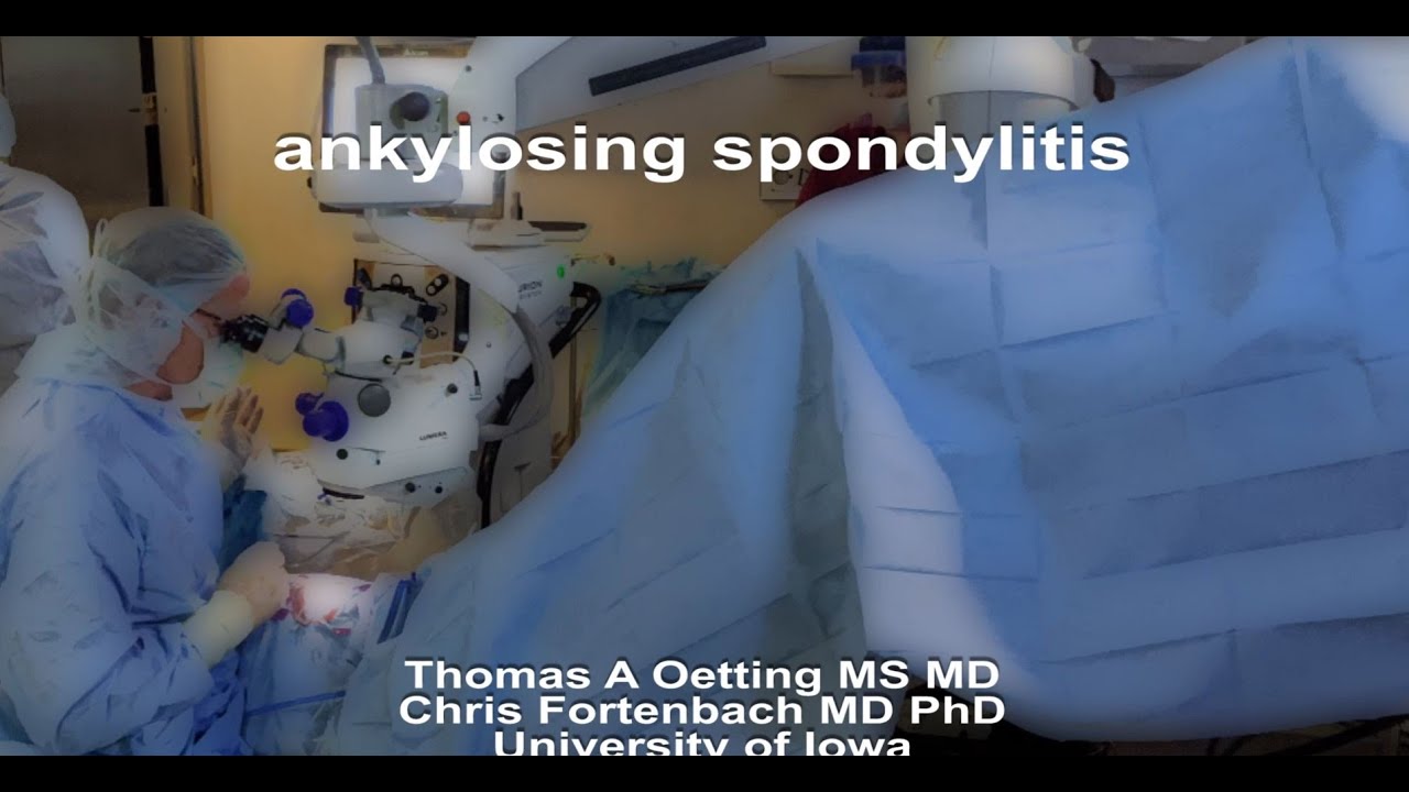 positioning for cataract surgery with advanced kyphosis - YouTube