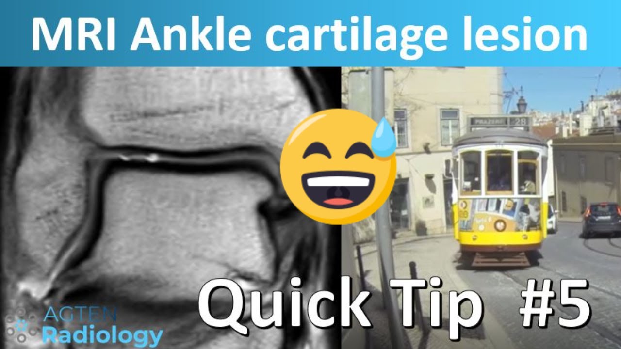Tram Track Lesion on Ankle MRI (MSK Quick Tip) - YouTube