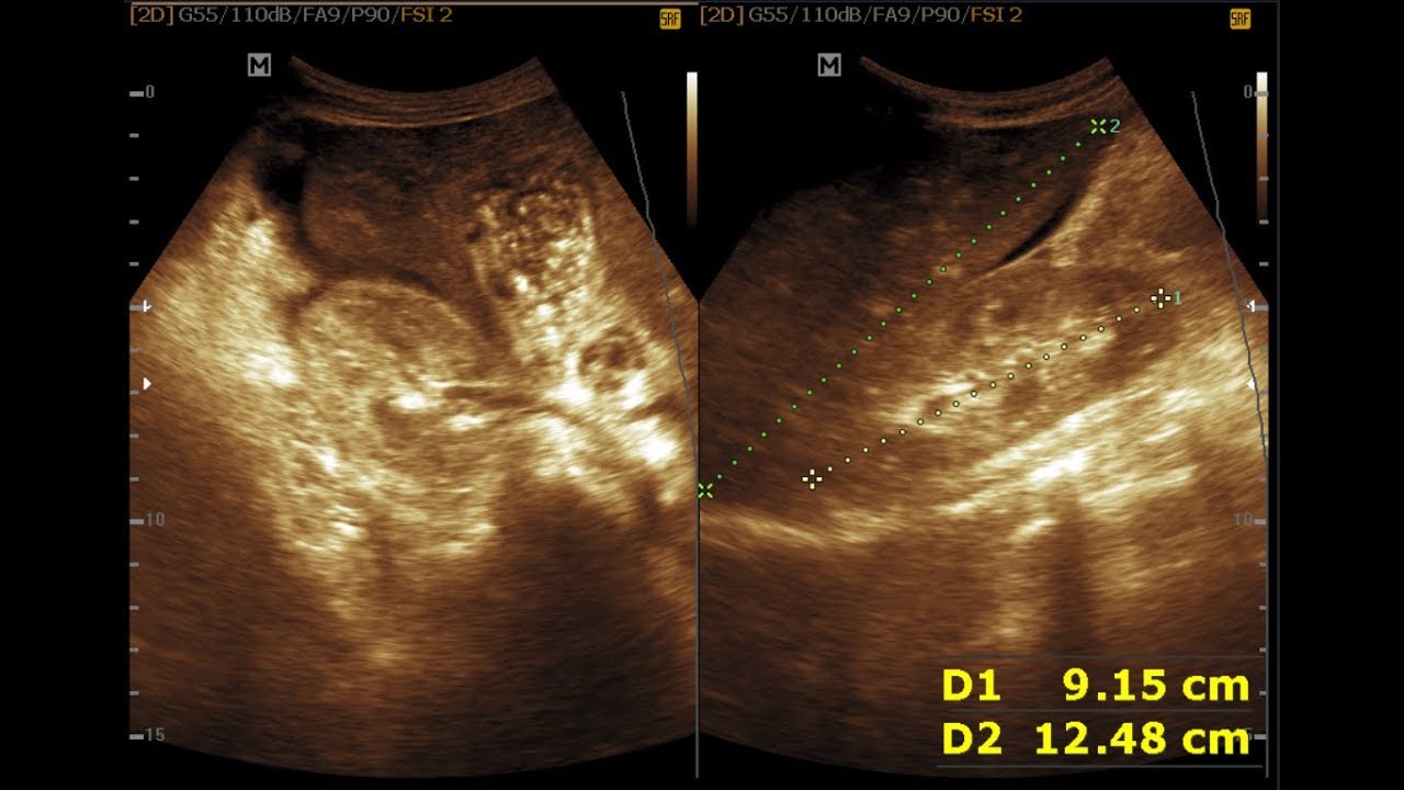 Liver metastasis Gall Bladder Sludge Ascites CKD - YouTube