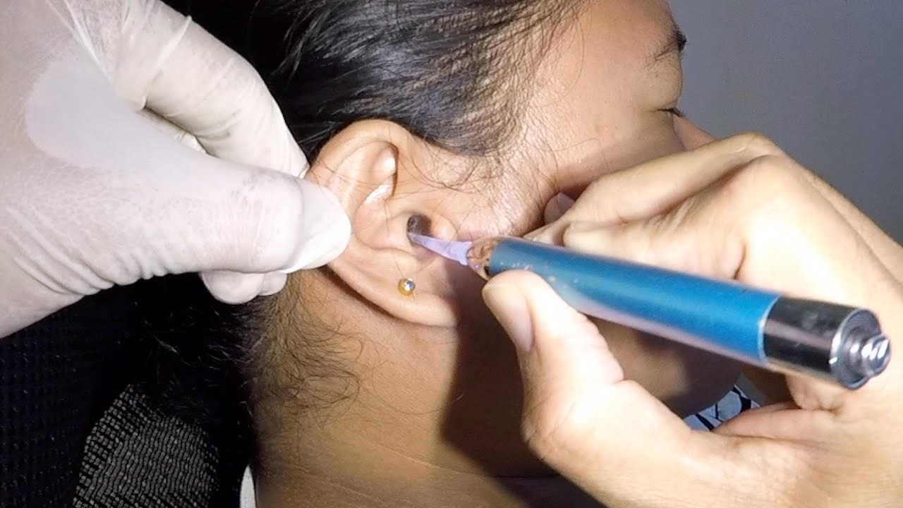 Removing Earwax Chunk Stuck in Woman's Ear - YouTube