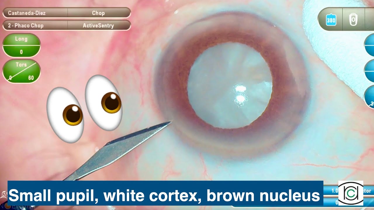 Small pupil, white cortex, dark nucleus Phaco time. - YouTube