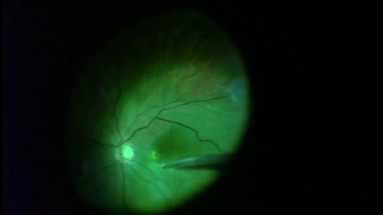 ERM Macular Pucker After Retinal Detachment - YouTube
