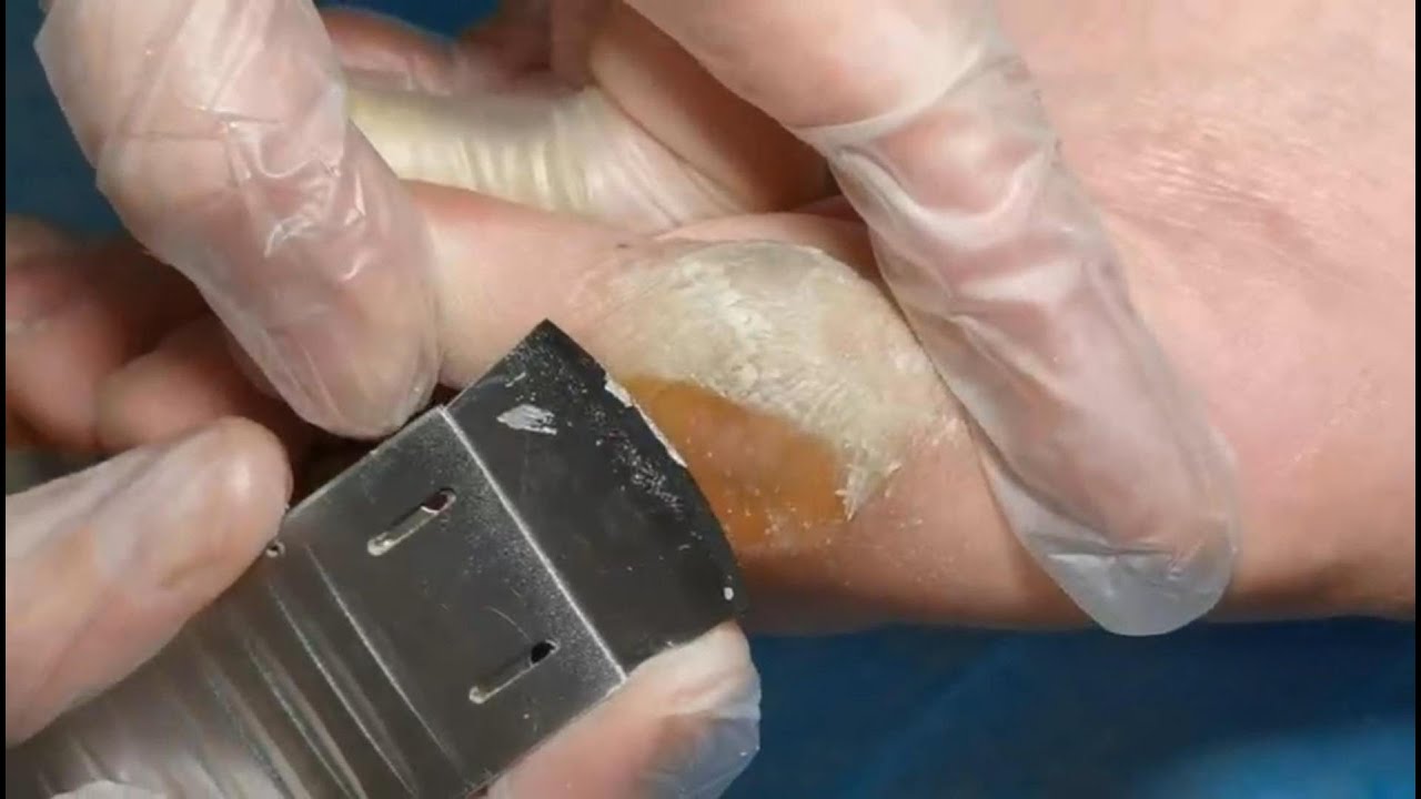 SO SATISFYING. Do you wanna watch this ? Cracked heel treatment ...