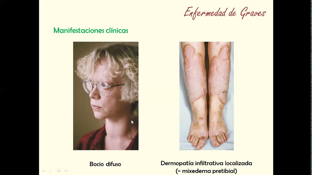 Patologia Do Mixedema Pre Tibial