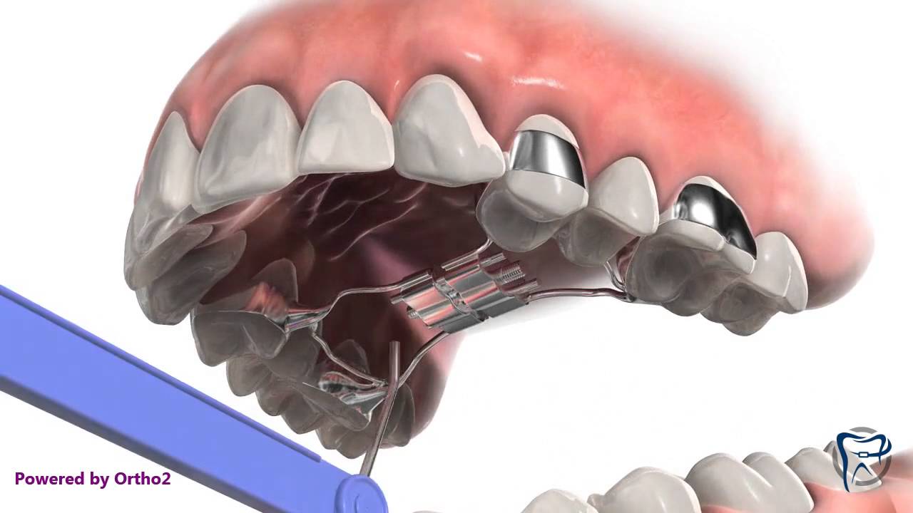 4-Banded Expander - YouTube