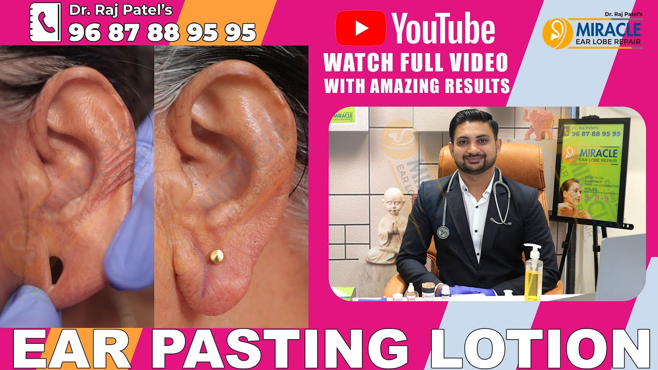 कान के बढ़े हुए छेद बंद करें / Ear lobe repair kaise kare👂👂 | ear ...