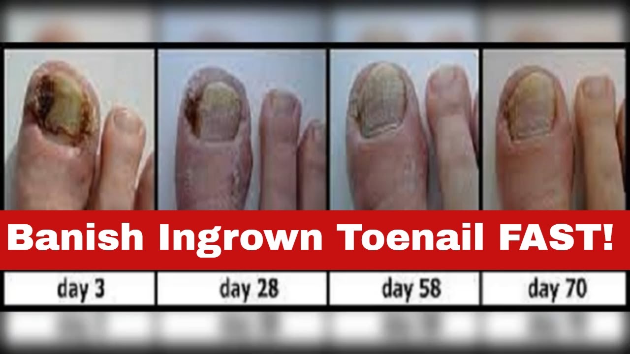 How to Get Rid of Ingrown Toenail: Fast, Easy DIY Steps! - YouTube