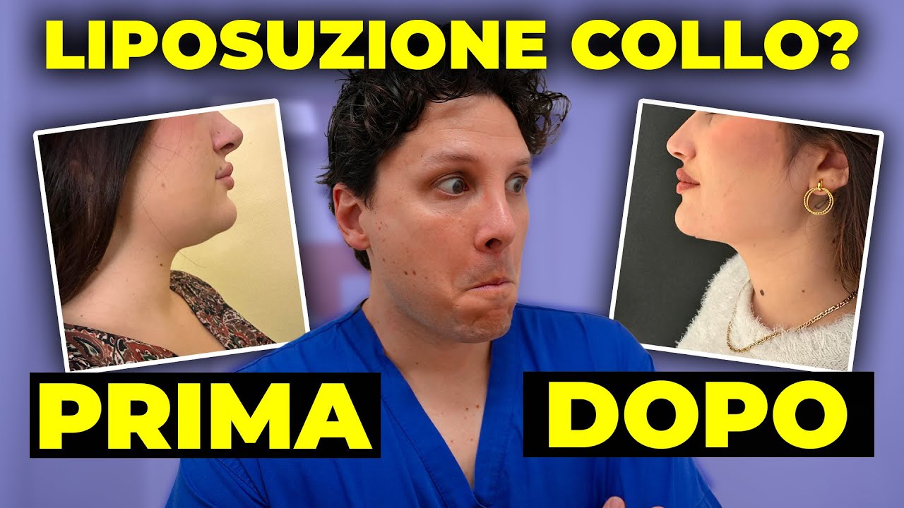LIPOSUZIONE COLLO: l'intervento di Chiara | Dott. Claudio Maestrini ...