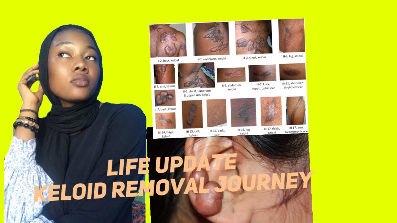 Life update … my keloid removal journey…. Advice and lesson learnt ...