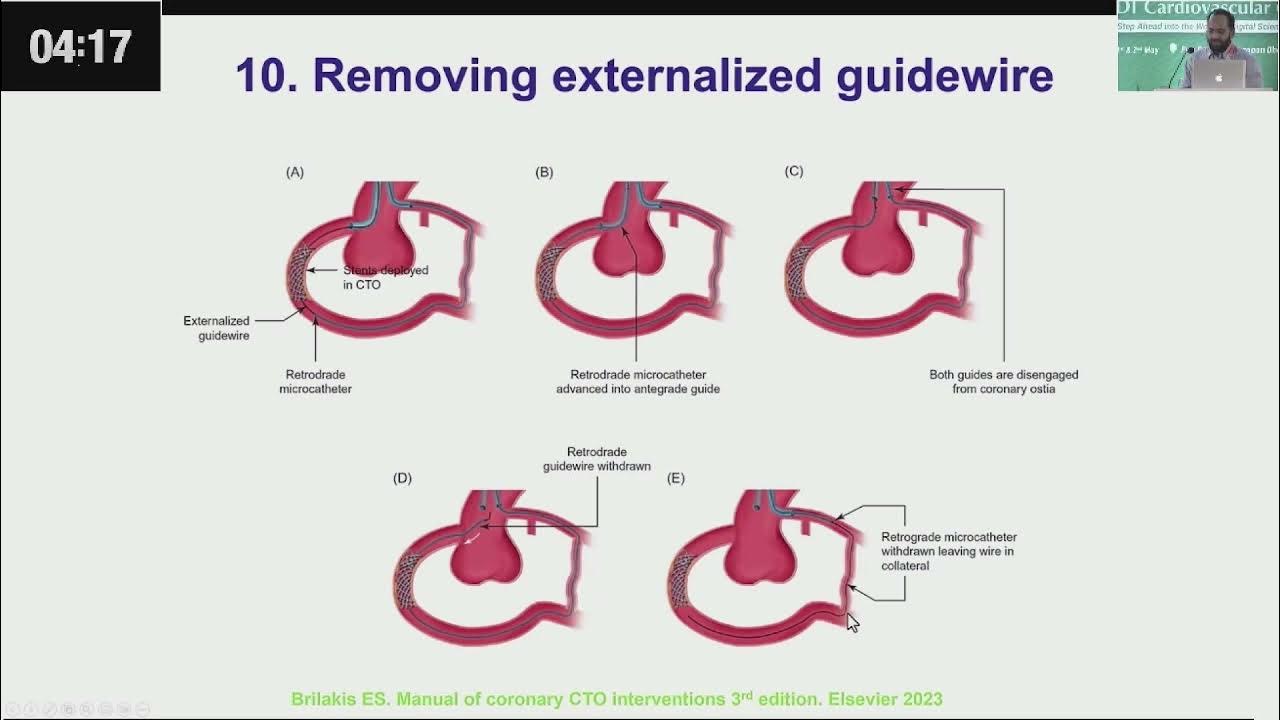 Retrograde CTO PCI: Tips & Tricks, Wire Externalization by Dr Aftab khan - YouTube