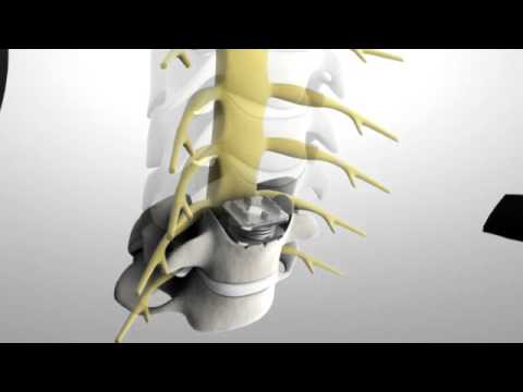 Procedimento - Disco Cervical Artificial M6-C - YouTube