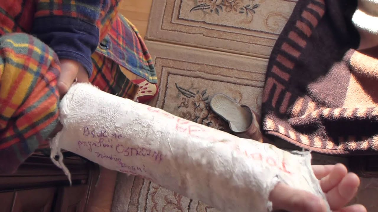 Złamana ręka, broken hand, - YouTube