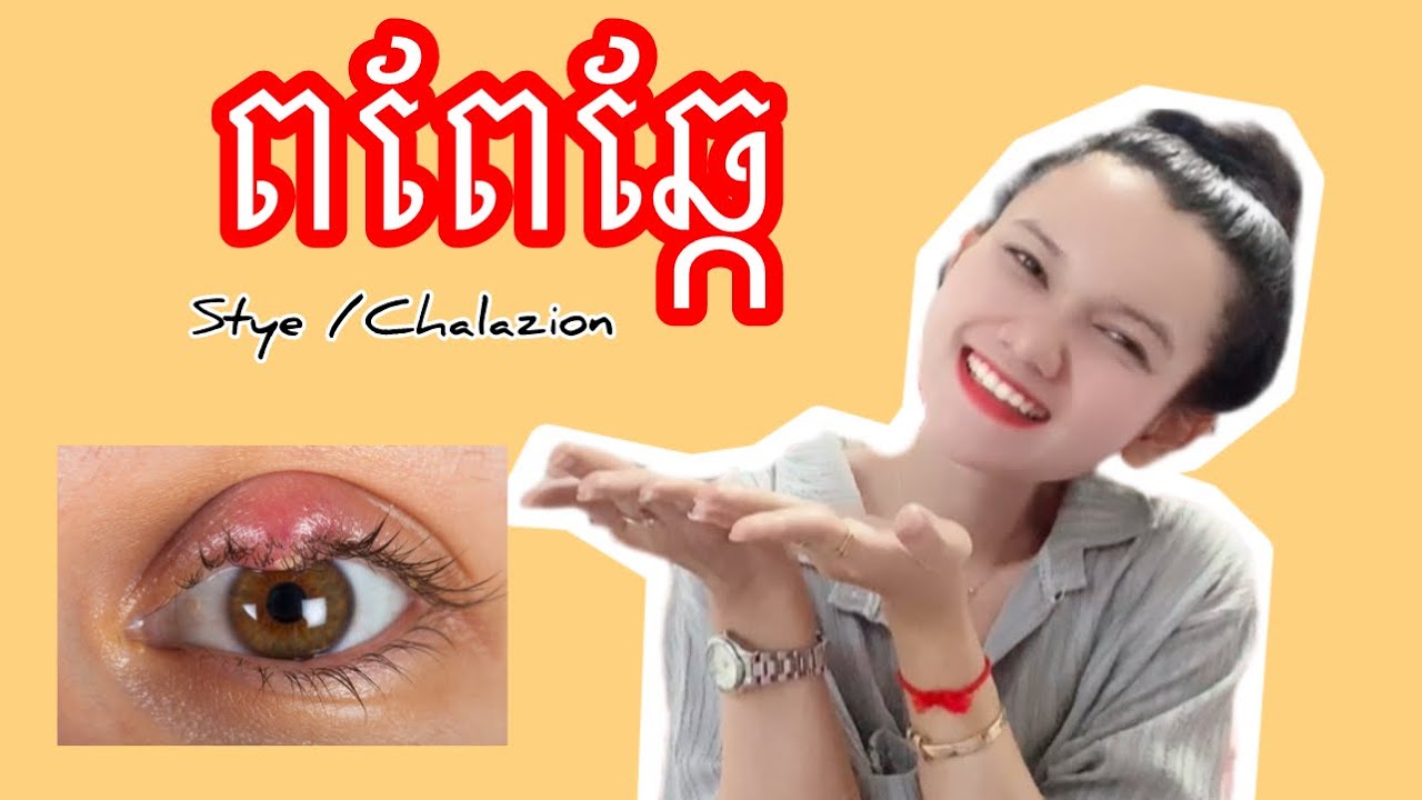 កើតពពែឆ្កែ គួរធ្វើមិចទើបឆាប់បាត់?-Stye/Chalazion »thychenghouy - YouTube