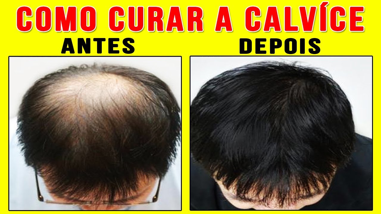 Calvice: MÉTODO SIMPLES E FÁCIL PARA Tratar a CALVICE E ACABAR De VEZ ...