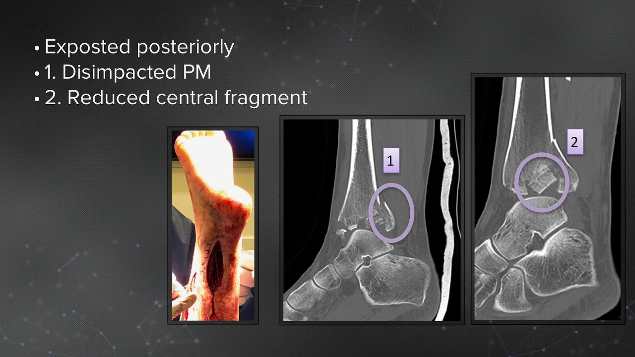 Pilon Fracture - YouTube