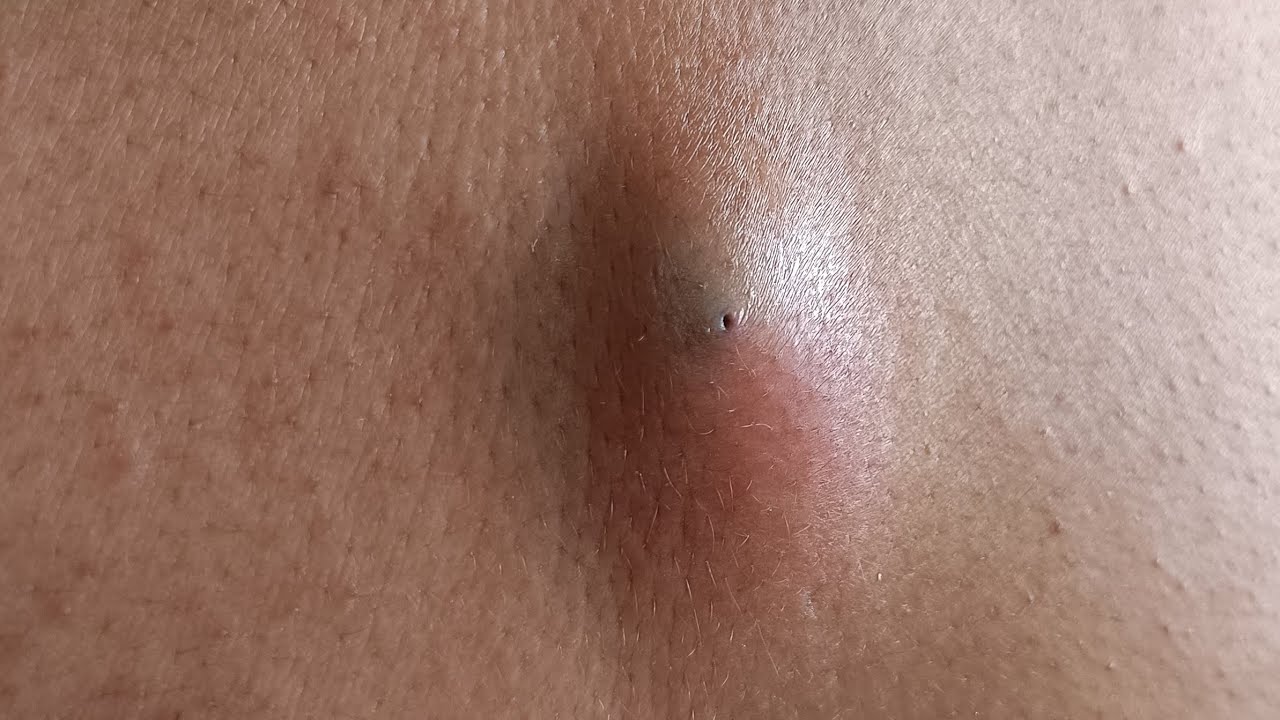 sebacious cyst excision#cosmeticsurgery of#sebacious cyst by Dr ...