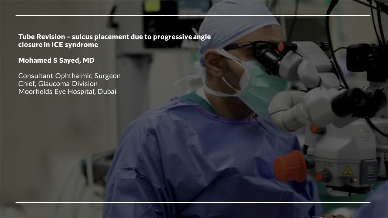 Tube Revision – sulcus placement due to progressive angle closure in ...