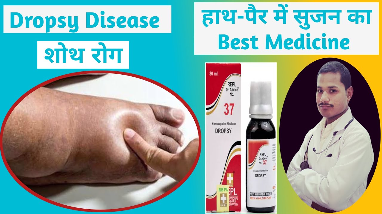 पैरो में सुजन का इलाज।Dropsy ka Homeopathic Medicine। हाथ, पैर में सुजन ...