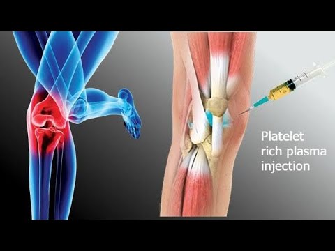 PRP (Platelet rich plasma): The safe and Effective Solution for Early ...