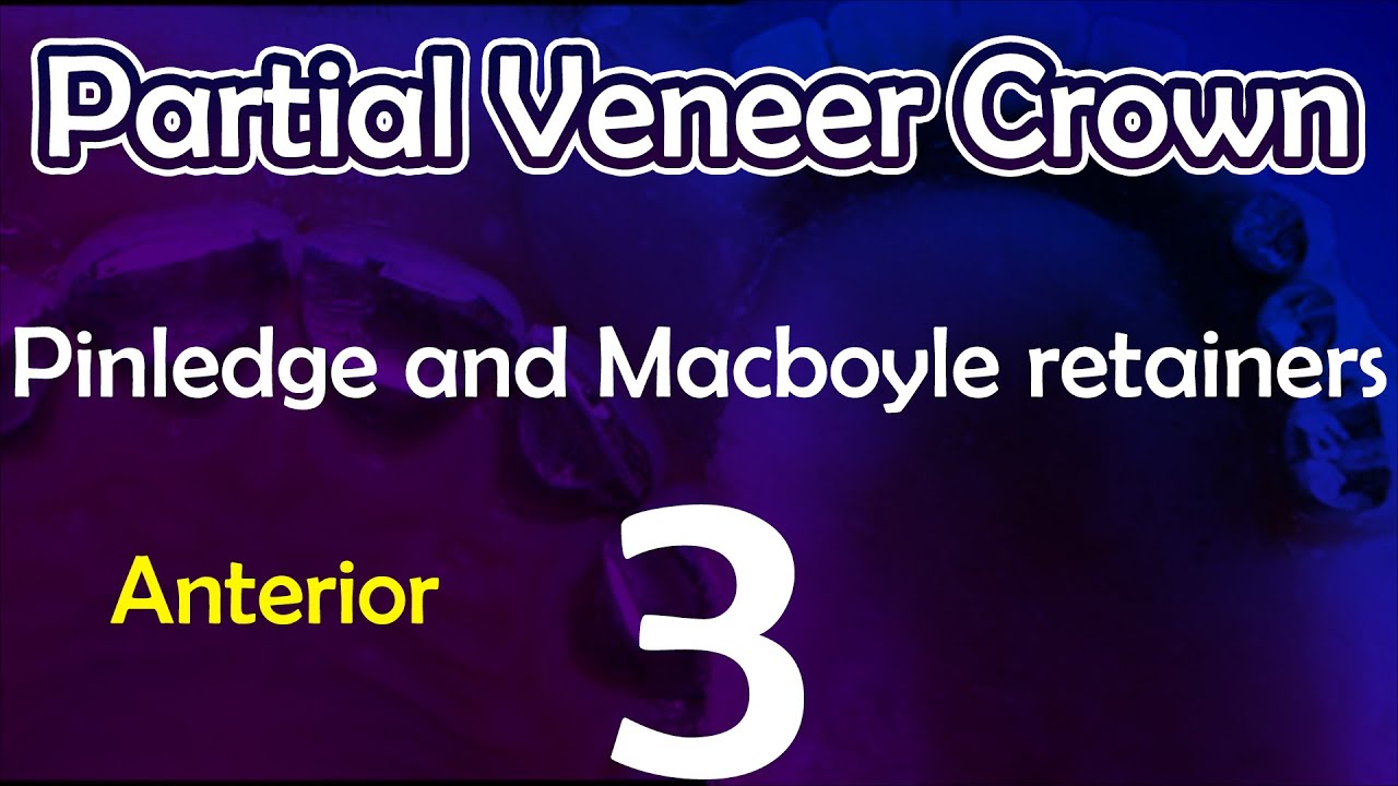 crown|partial veneer crown (pinledges and Macboyle retainers)3 - YouTube