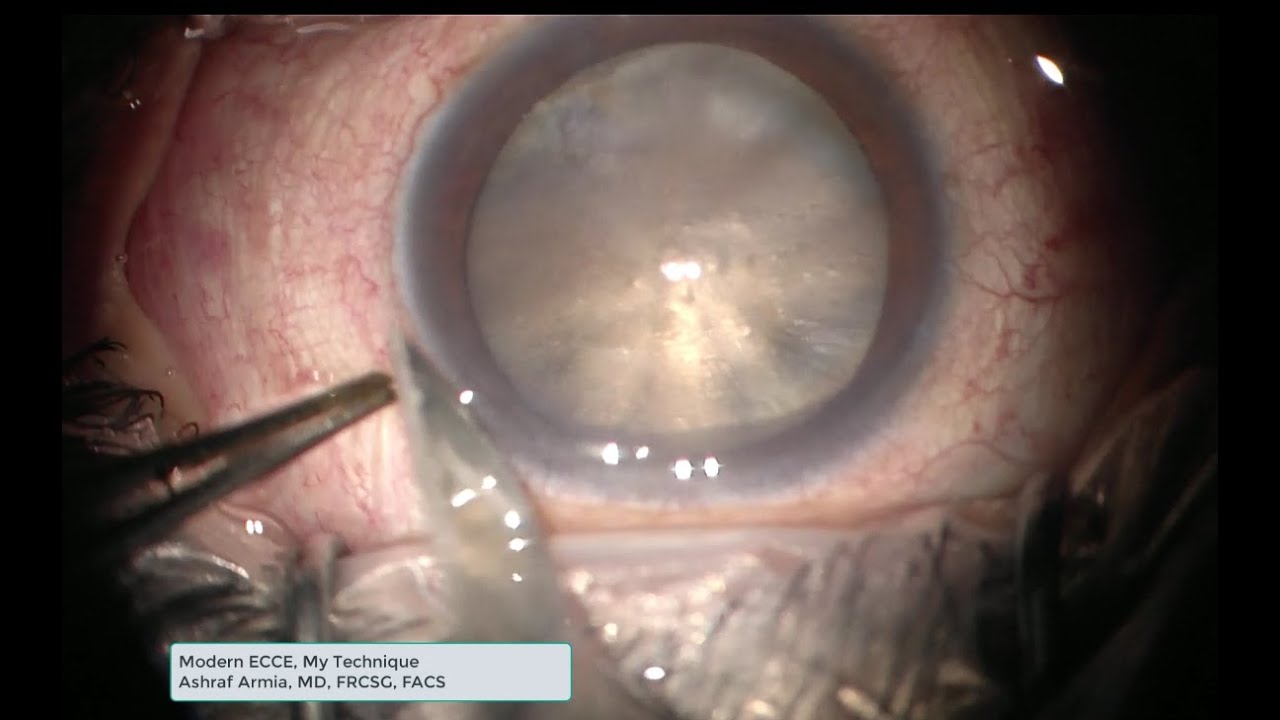 ECCE, My Technique For Modern ECCE, Dr Ashraf Armia - YouTube