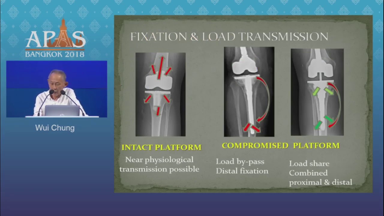 Rational basis for use of Sleeves and cones in revision TKR - Wui Chung ...